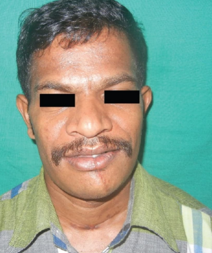 Man Presented with A Penetrating Facial Injury by A Wooden Log ...