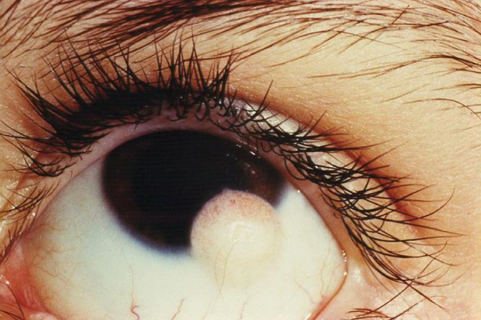 Misplaced eyelash or ingrown hair in the eye? - MEDizzy Journal