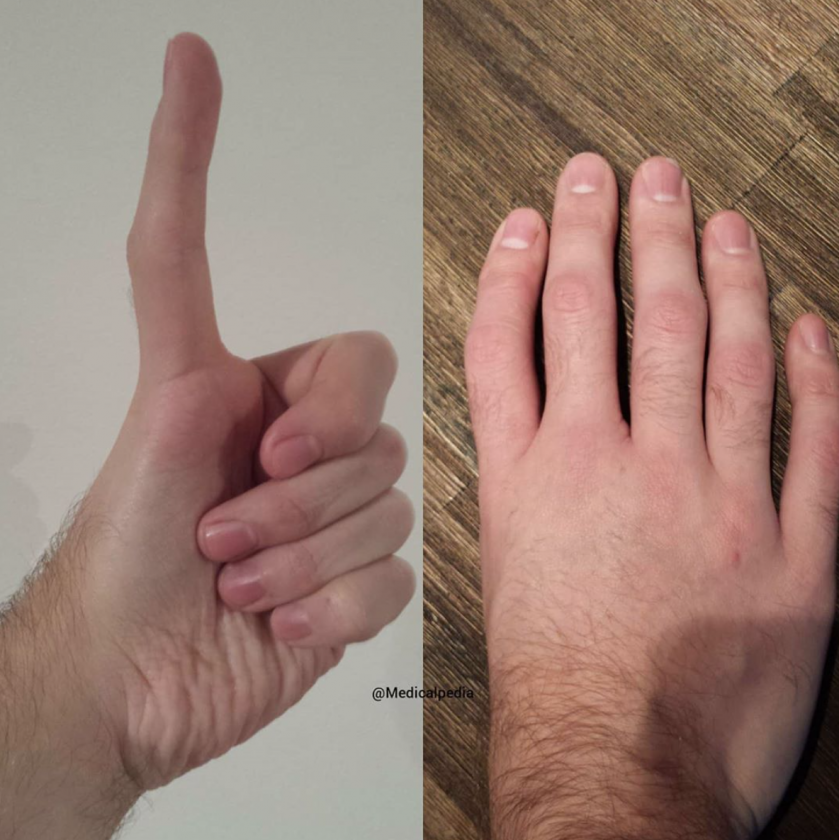An interesting case of triphalangeal thumb - MEDizzy Journal