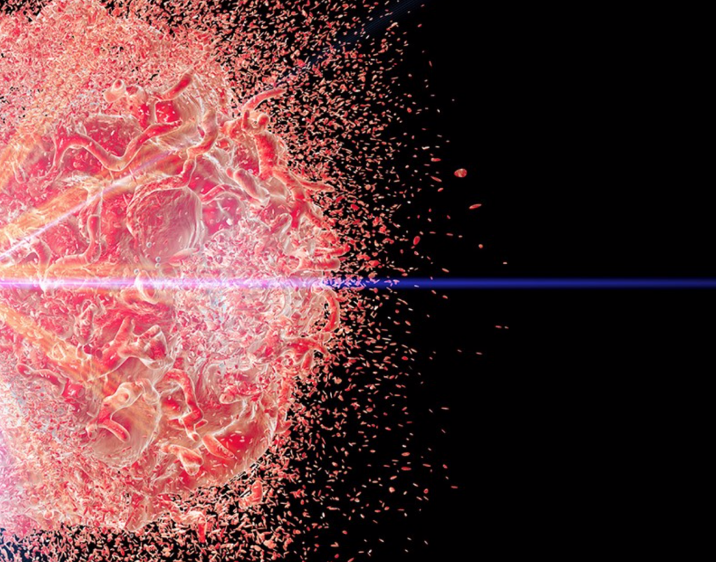 Multidisciplinary management of early rectal cancer: What are the ...