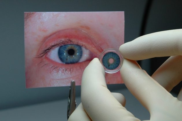 The CustomFlex artificial iris - MEDizzy Journal