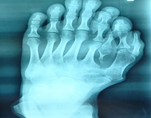 Is polydactyly a good omen or bad? - MEDizzy Journal