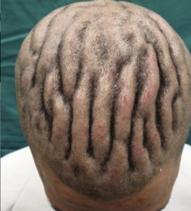Mounds, ridges, and valleys on the scalp. Spot diagnosis? Mounds, ridges, and valleys on the scalp. Spot diagnosis?