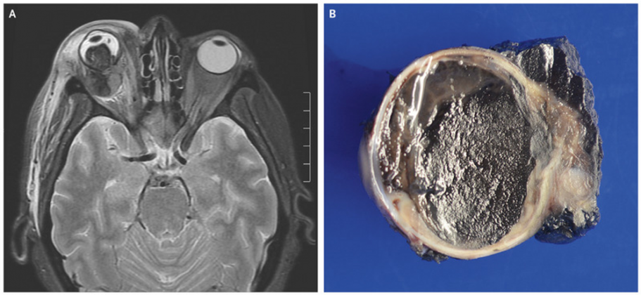 Inflammation And Pain In 56-Year-Old Woman's Right Eye Caused By ...