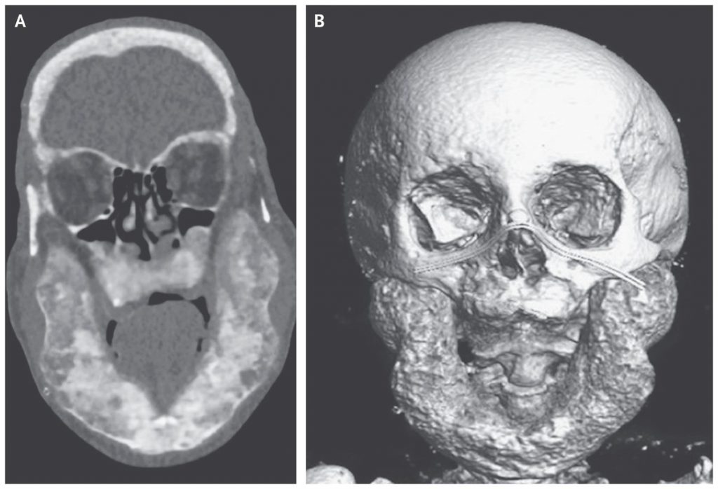 Osteitis Fibrosa Cystica... Is it Malignant? - MEDizzy Journal
