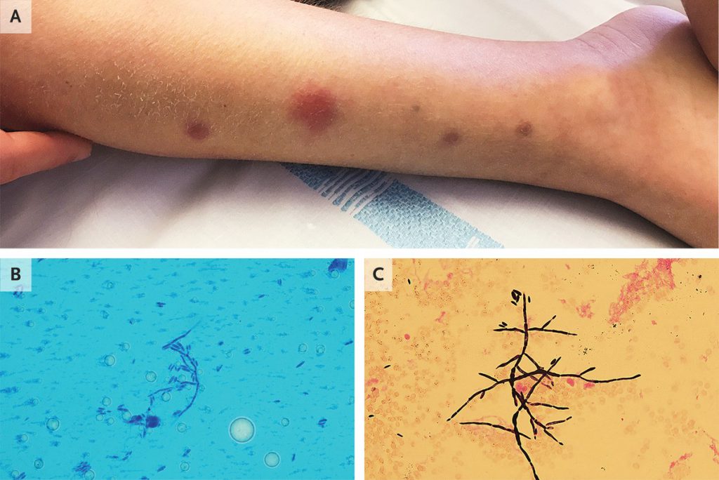 An 8-year-old Immunocompromised Boy With Disseminated Fungal Infection ...