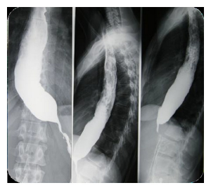 Corkscrew Esophagus - MEDizzy Journal