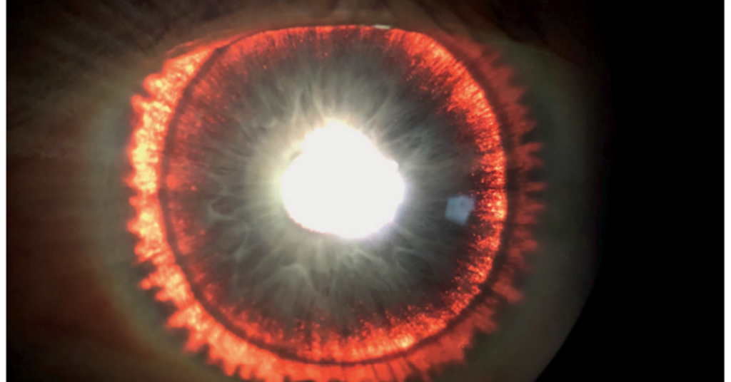 44-Year-Old Patient Presents With Circumferential Spoke-like Iris ...