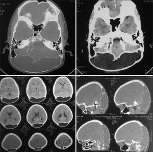 Growing Skull Fracture in Posterior Cranial Fossa - MEDizzy Journal