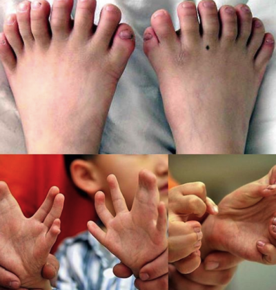 A 6-Year Old Boy Born With 31 Fingers and Toes - MEDizzy Journal