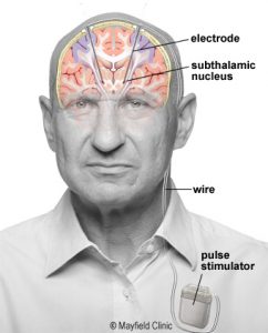 Brain Pacemaker - MEDizzy Journal