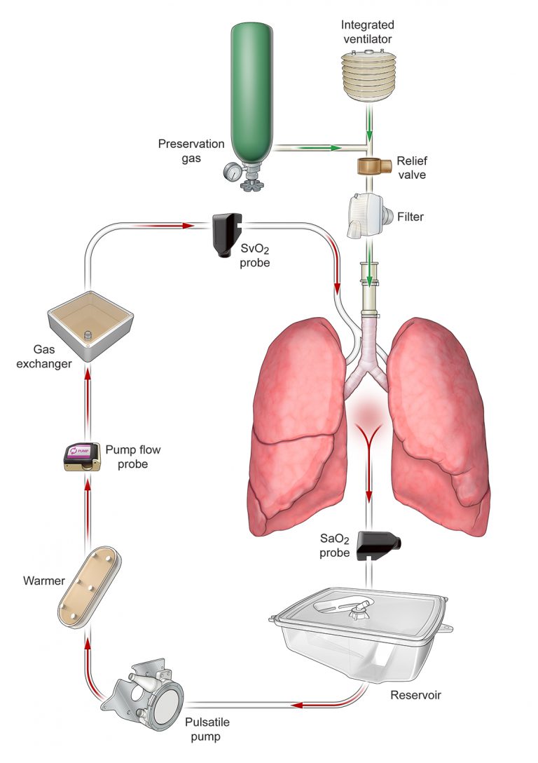 Lungs Perfused Outside the Body- An Innovative Donor Lung Preserving ...