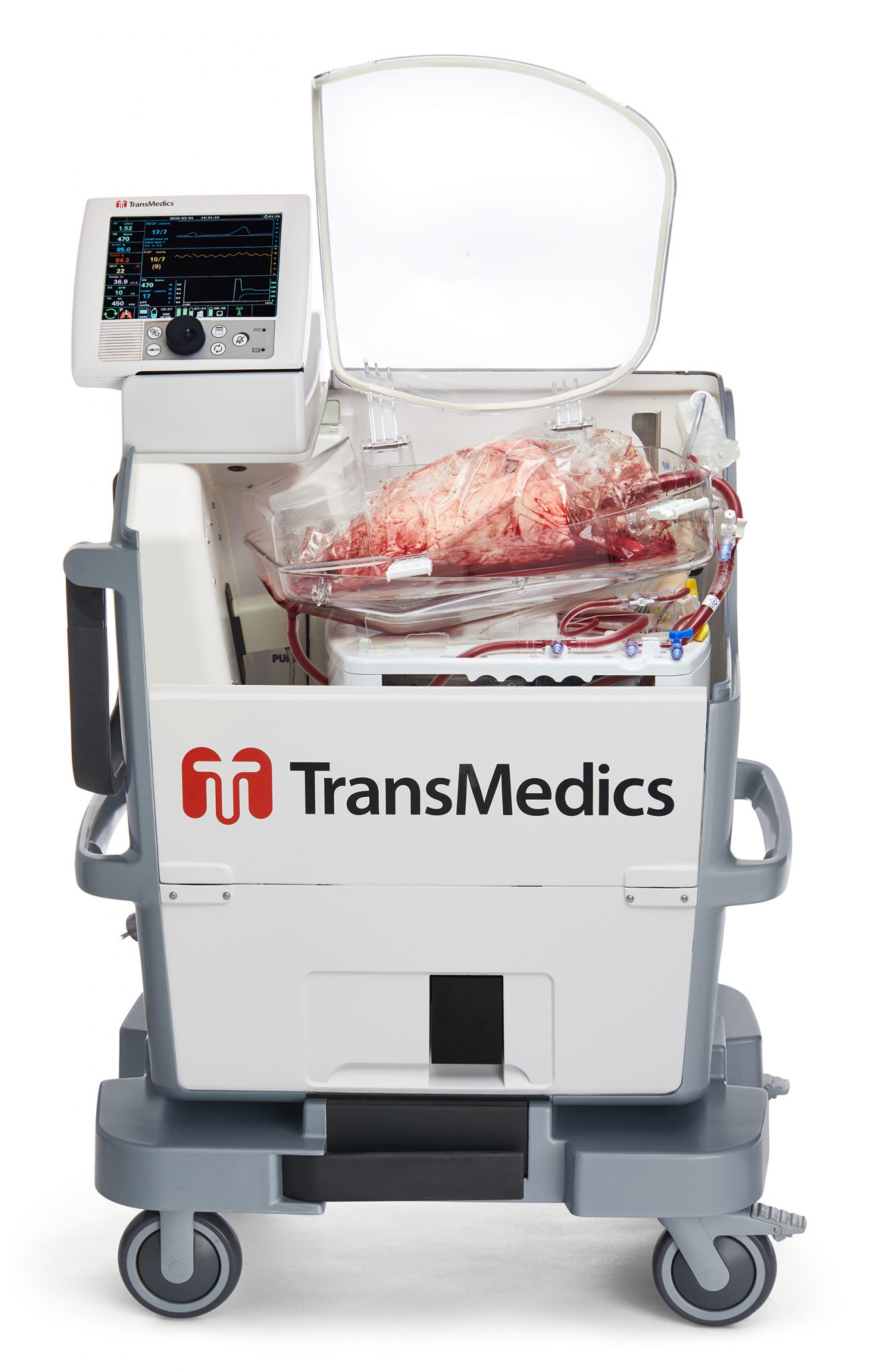 Lungs Perfused Outside the Body- An Innovative Donor Lung Preserving ...