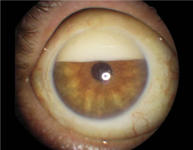 Emulsification of Silicone Oil in the Eye - MEDizzy Journal