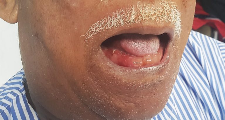 'Double Tongue' Appearance due to Swelling of the Floor of Mouth ...