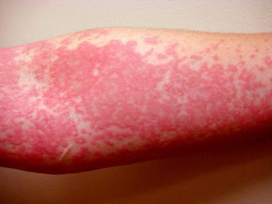 Allergic To Water Aquagenic Urticaria Medizzy Journal