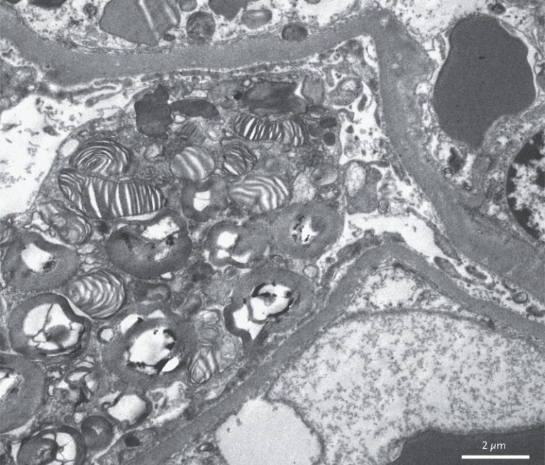 Zebras In The Nephrology Clinic - MEDizzy Journal