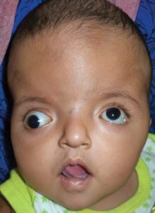 Apert Syndrome: Only 300 cases since 1894! - MEDizzy Journal