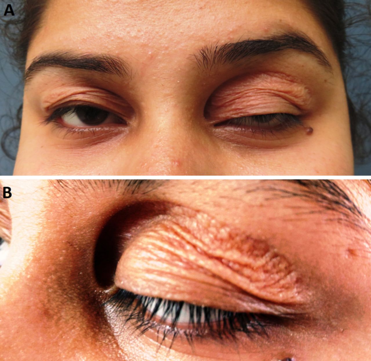 Cutis Laxa: Makes you look much older! - MEDizzy Journal