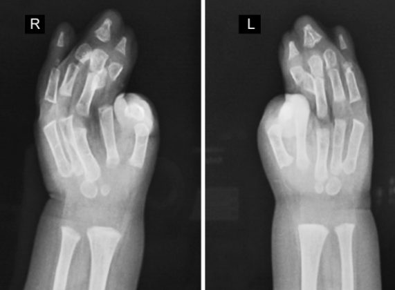 Apert Syndrome: Only 300 cases since 1894! - MEDizzy Journal