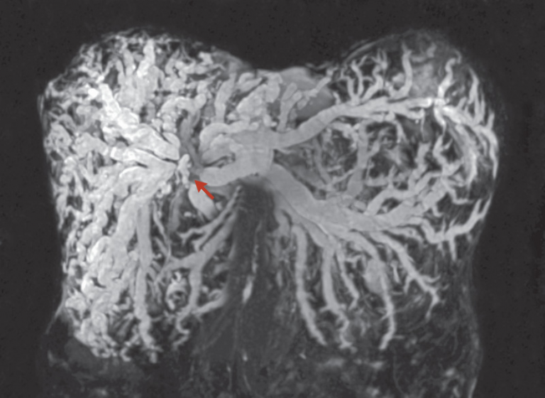 Intrahepatic Bile Duct Dilation Due To Cholangiocarcinoma - MEDizzy Journal