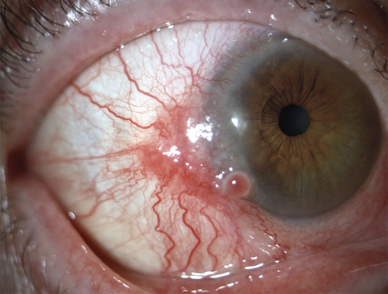Conjunctival Cancer - MEDizzy Journal