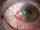 Conjunctival Cancer - MEDizzy Journal