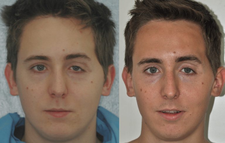 Remarkable Facial Reconstruction Surgery - MEDizzy Journal