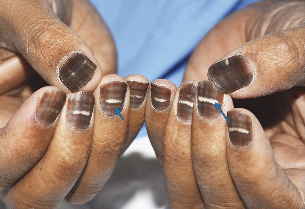 Transverse Lines on Fingernails- Differentials? - MEDizzy Journal