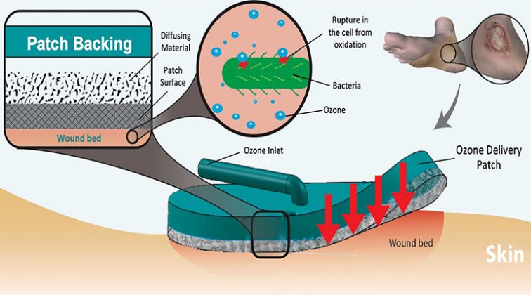 Ozone Gas- A New Hope For Treating Chronic Wounds - MEDizzy Journal