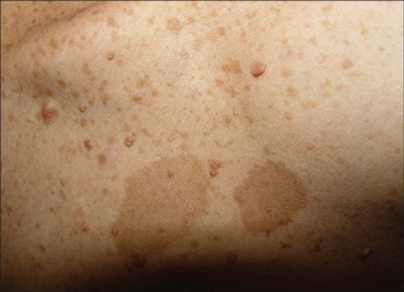 A Family Case Report Of Neurofibromatosis Type 1