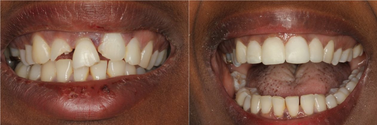 Treatment And Restoration Of Dentoalveolar Trauma