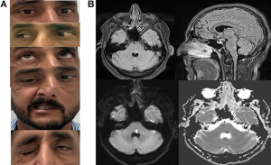 Eight-and-a-half Syndrome - MEDizzy Journal