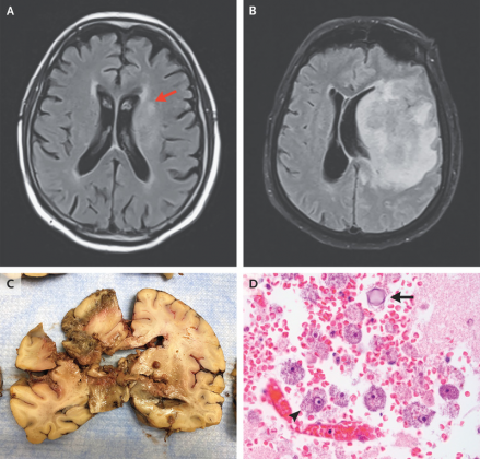 Amebic Brain Infection In 82-year-old Male Patient