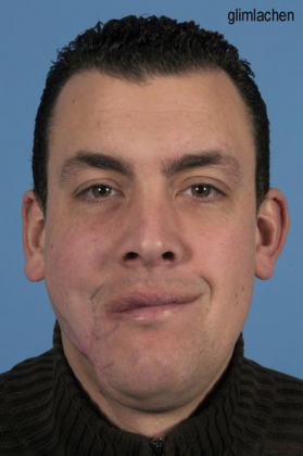 Facial Trauma Caused By Recreational Fireworks In 29-Year-Old