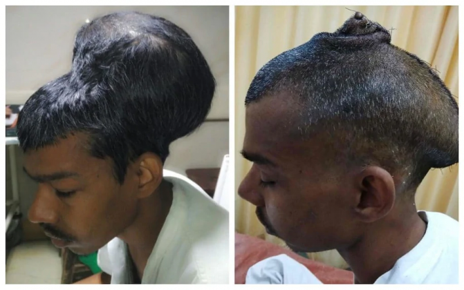 Case Of World's Largest Brain Tumour - MEDizzy Journal