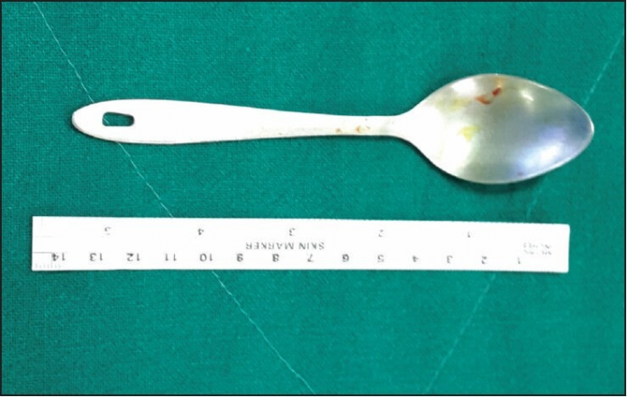 Laparoscopic Retrieval Of Spoon From Stomach - MEDizzy Journal