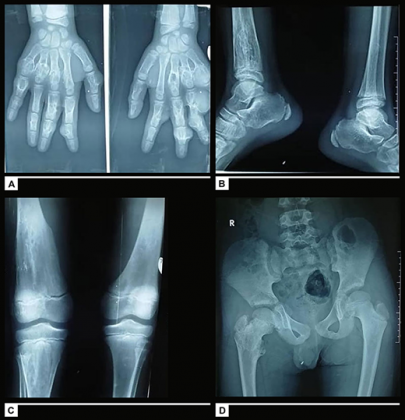 Ollier Disease - MEDizzy Journal