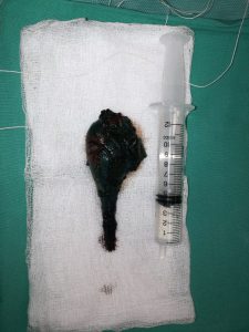 Branchial Cleft Cyst and Blue Urine…. Are The Two Correlated? - MEDizzy ...