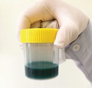 Branchial Cleft Cyst and Blue Urine…. Are The Two Correlated? - MEDizzy ...