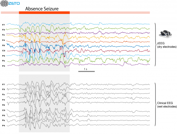 EEG Revolutionized - MEDizzy Journal
