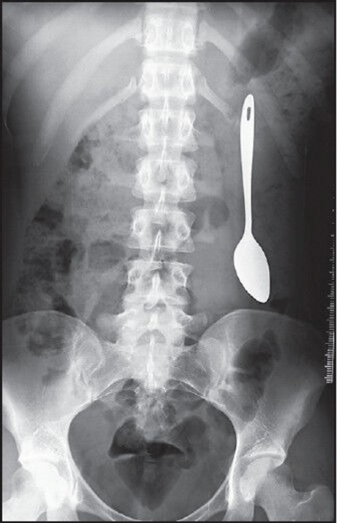 Laparoscopic Retrieval Of Spoon From Stomach - MEDizzy Journal