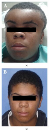 Complication Of Frontal Sinusitis: Frontoparietal Abscess - MEDizzy Journal