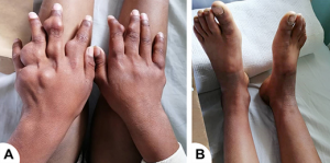 Ollier Disease - MEDizzy Journal