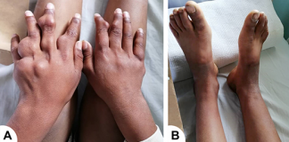 Ollier Disease - MEDizzy Journal