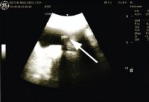Foreign Body In The Bladder - MEDizzy Journal