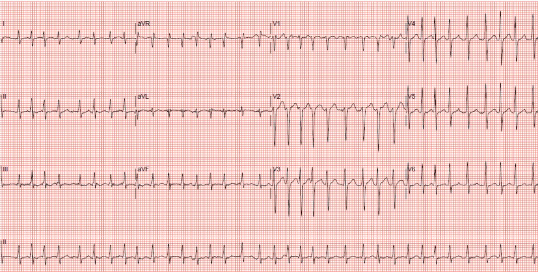 Use of E-cigarette Led to Cardiac Complications - MEDizzy Journal