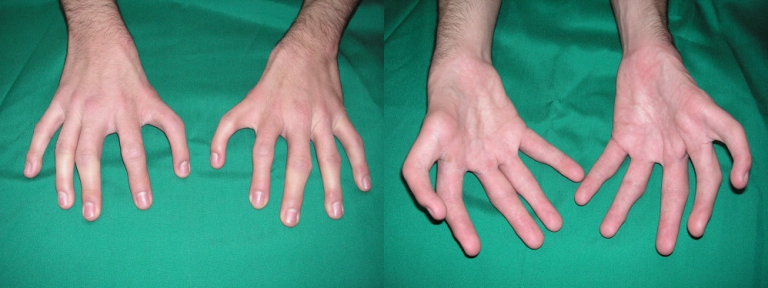 Case Of Five Finger Hands And PolyDactyly Of Feet