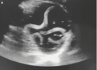 Ultrasound Reveals Roundworms in Man's Stomach - MEDizzy Journal