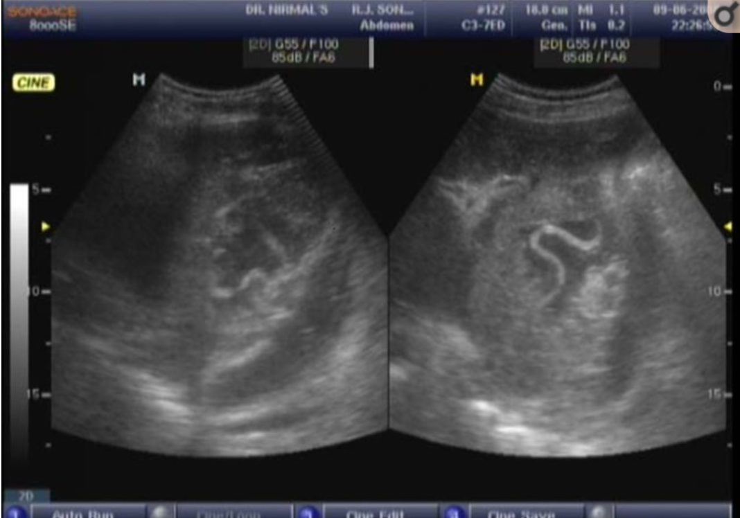 Ascariasis - Stomach Pain Can Be Due To Worms! - MEDizzy Journal